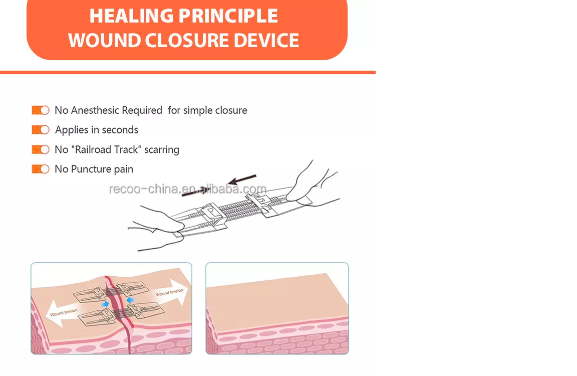 Free samples Wound Closure Device First Aid Laceration Closure Kit - 浙江 ...